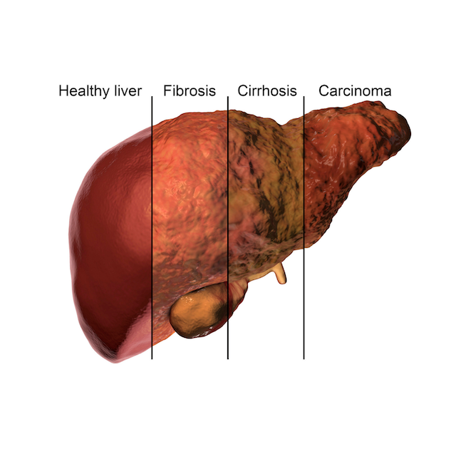 Cirrhosis – Home